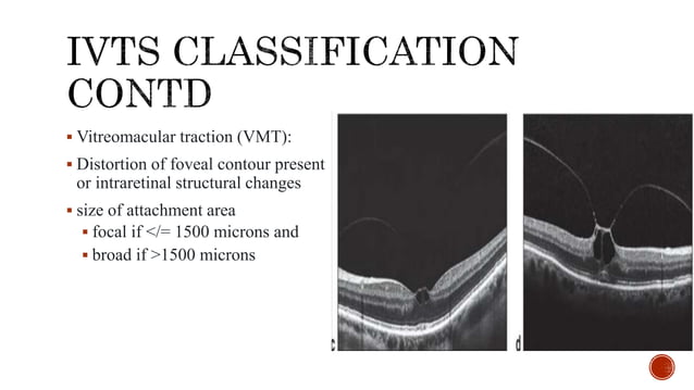 Pathogenesis and management of macular holes with video demonstration.pptx