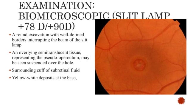 Pathogenesis and management of macular holes with video demonstration.pptx