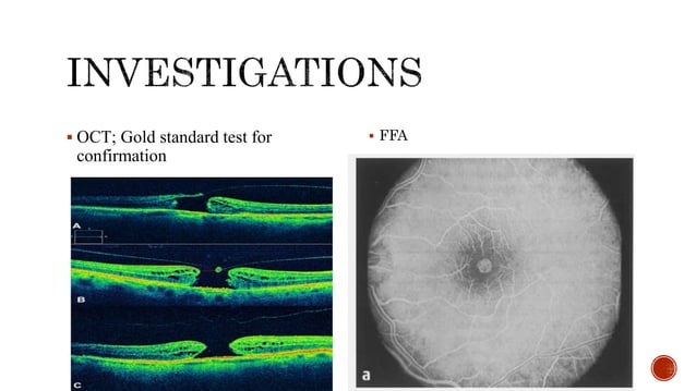 Pathogenesis and management of macular holes with video demonstration.pptx