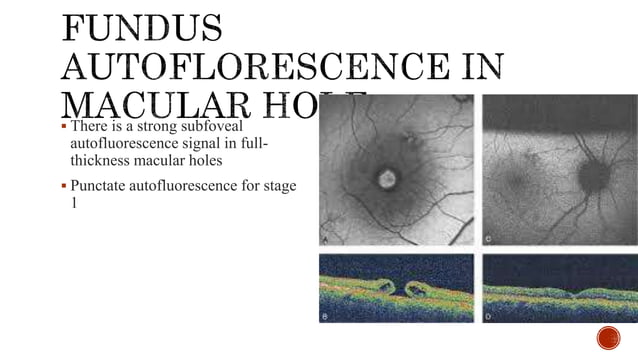 Pathogenesis and management of macular holes with video demonstration.pptx