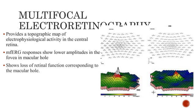 Pathogenesis and management of macular holes with video demonstration.pptx