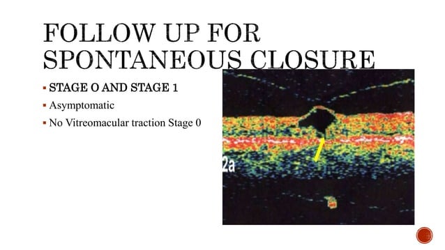 Pathogenesis and management of macular holes with video demonstration.pptx
