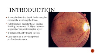 Pathogenesis and management of macular holes with video demonstration.pptx