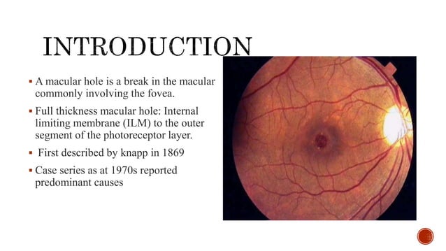Pathogenesis and management of macular holes with video demonstration.pptx