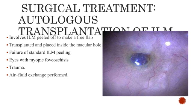 Pathogenesis and management of macular holes with video demonstration.pptx