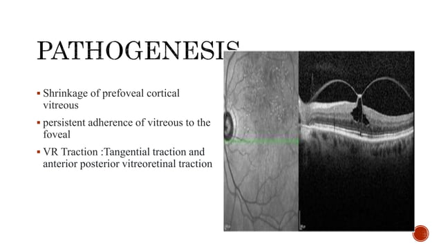 Pathogenesis and management of macular holes with video demonstration.pptx