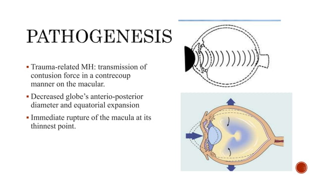 Pathogenesis and management of macular holes with video demonstration.pptx