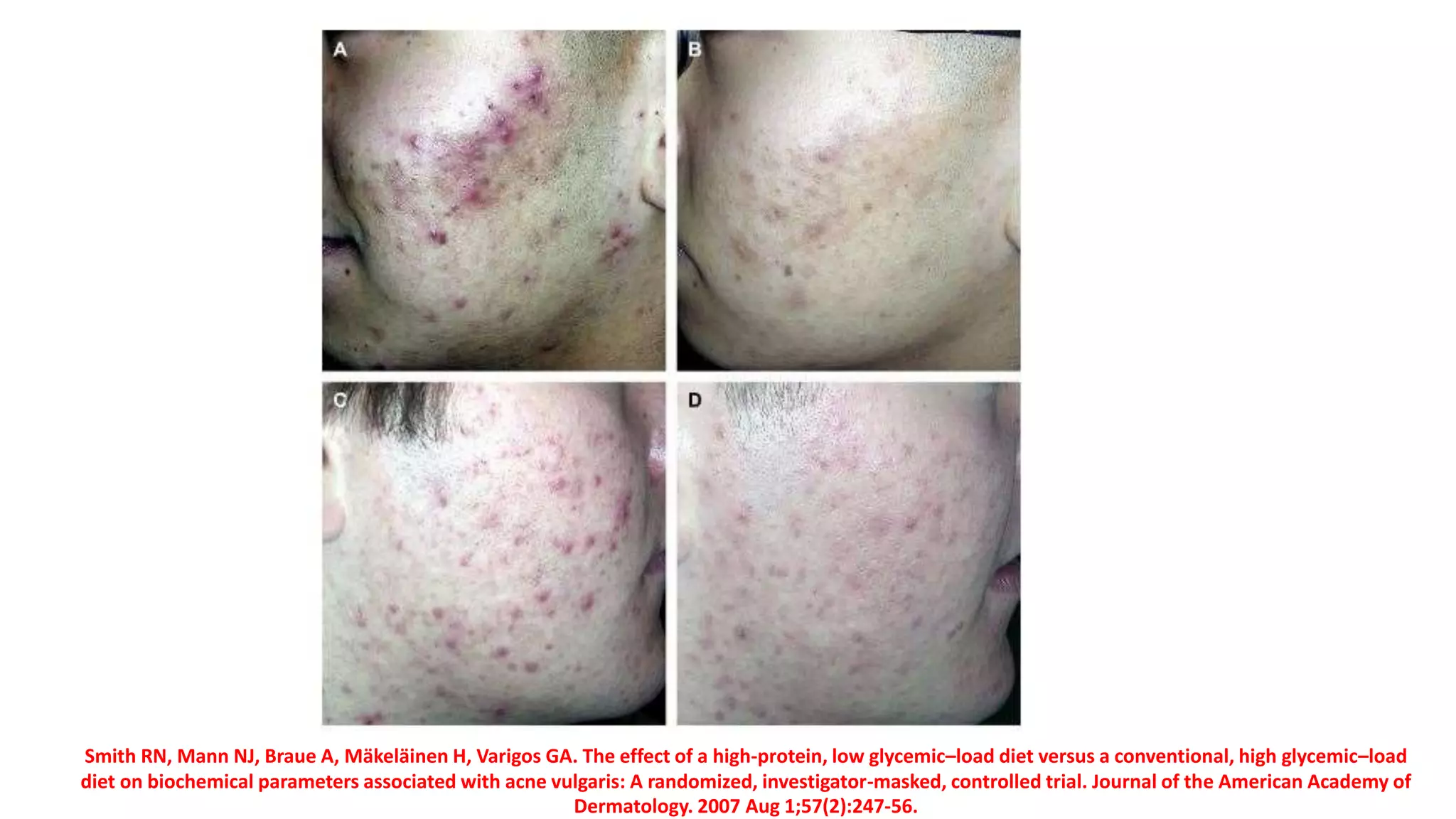 Pathogenesis of acne | PPT | Free Download