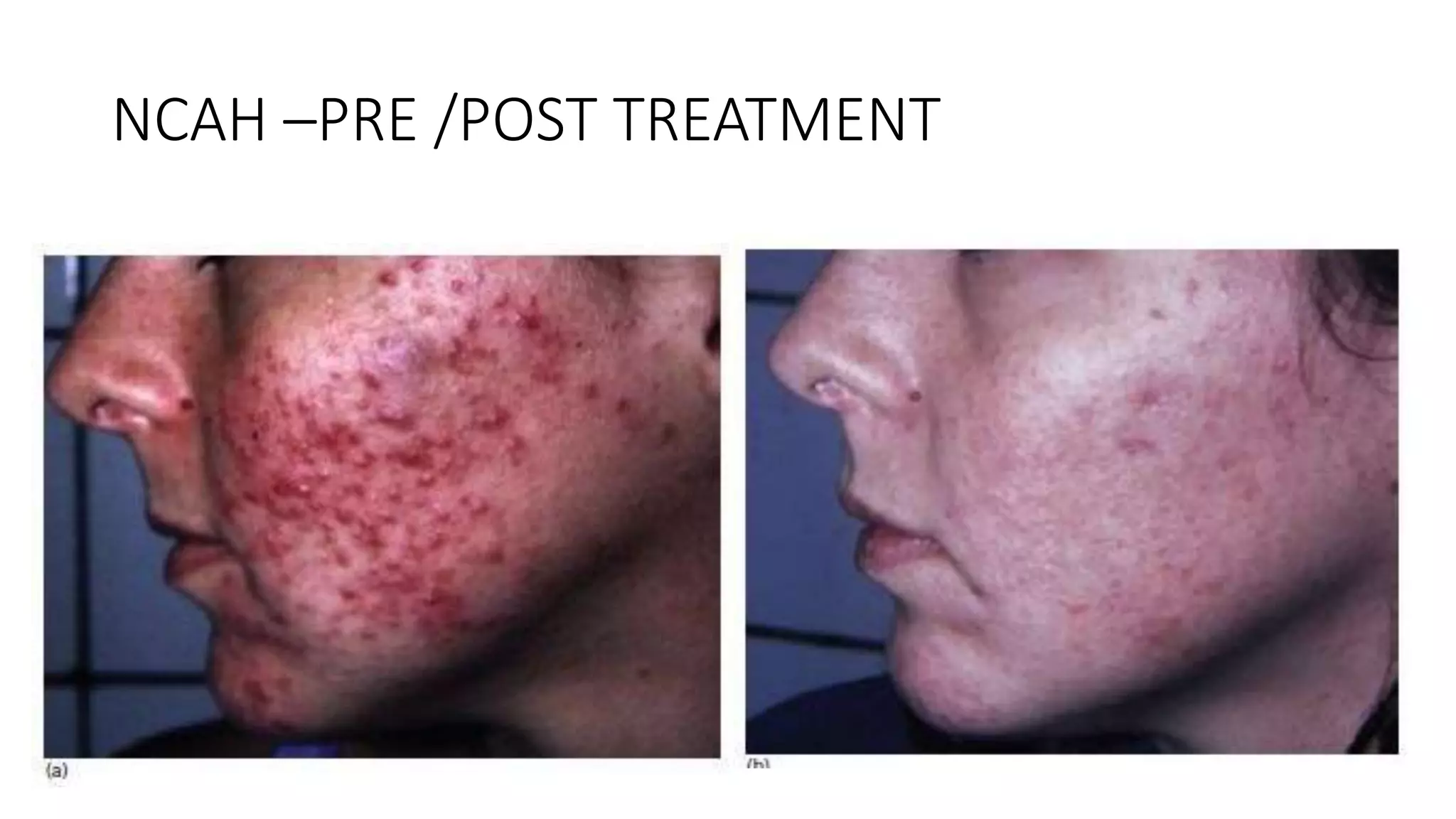 Pathogenesis of acne | PPT | Free Download
