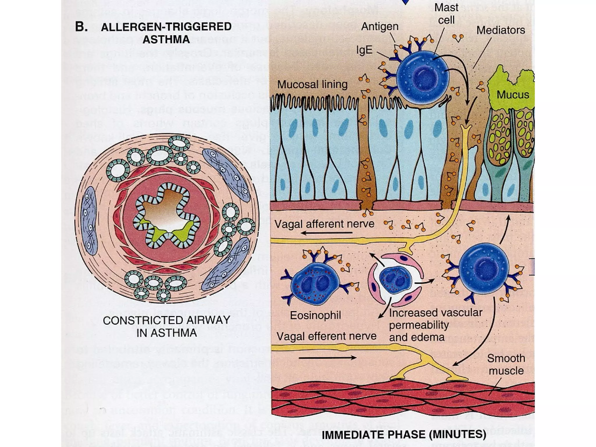Pathogenesis of bronchial asthma | PPT