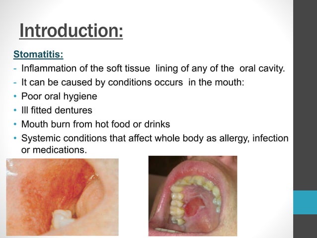 Pathogenesis of contact stomatitis | PPTX