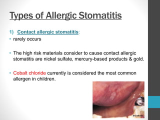 Irritant Contact Stomatitis
