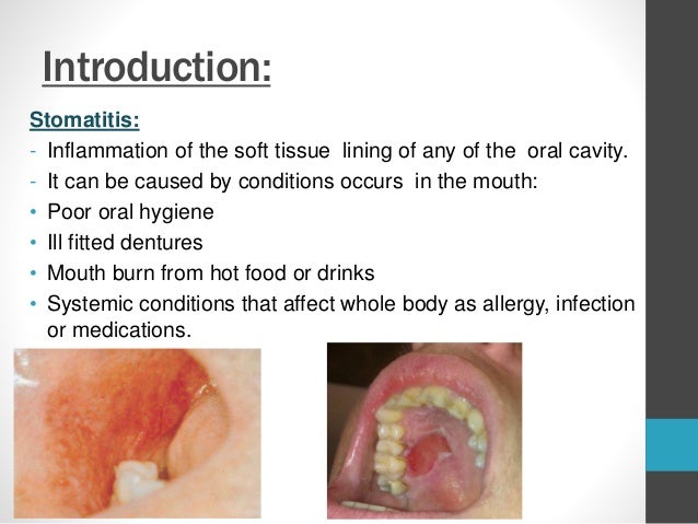 Pathogenesis of contact stomatitis
