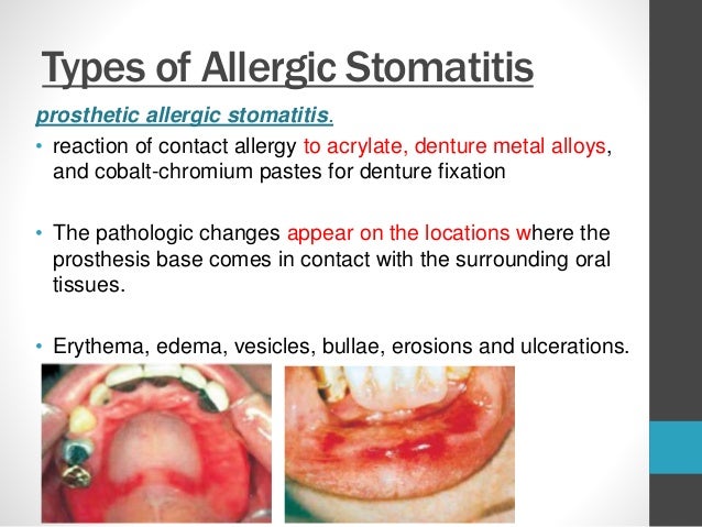 Pathogenesis of contact stomatitis