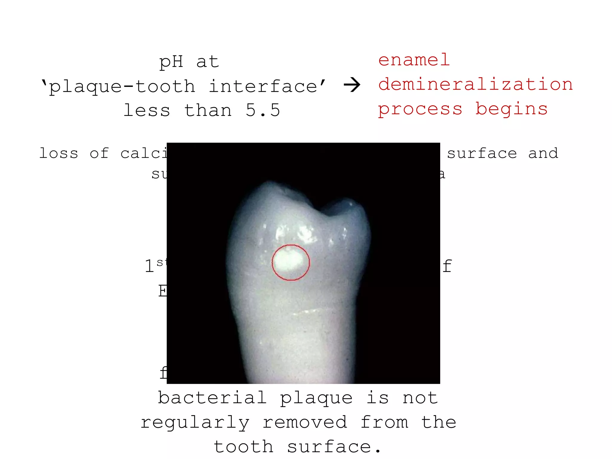 Pathogenesis of dental caries | PPSX