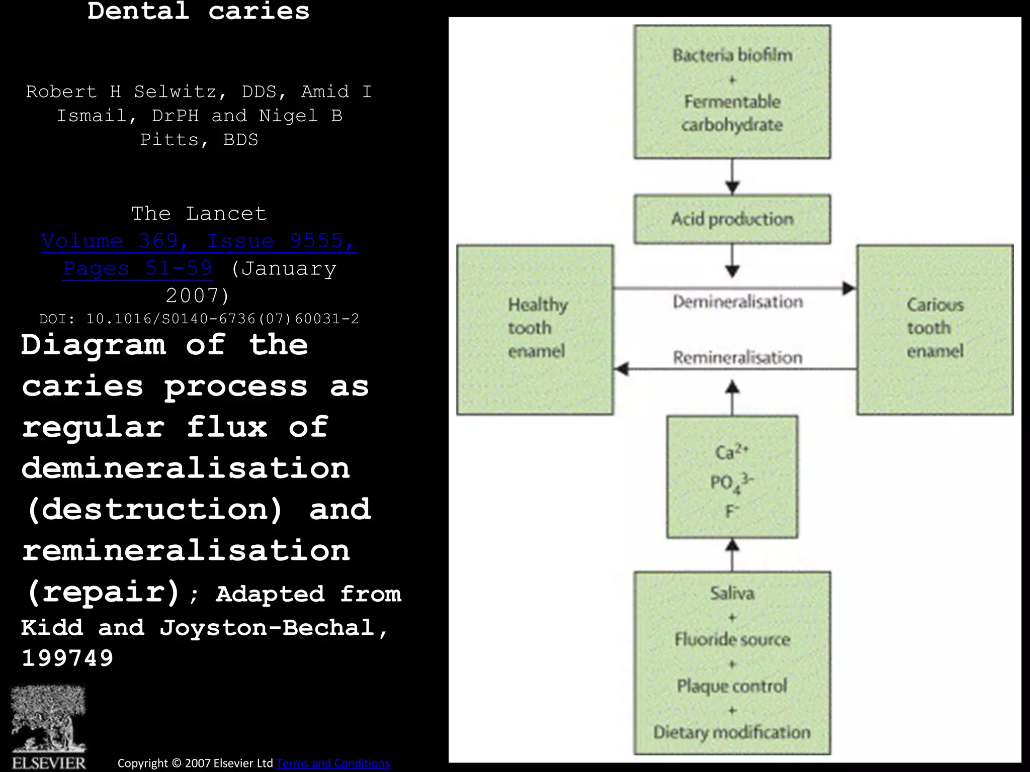 Pathogenesis of dental caries | PPSX