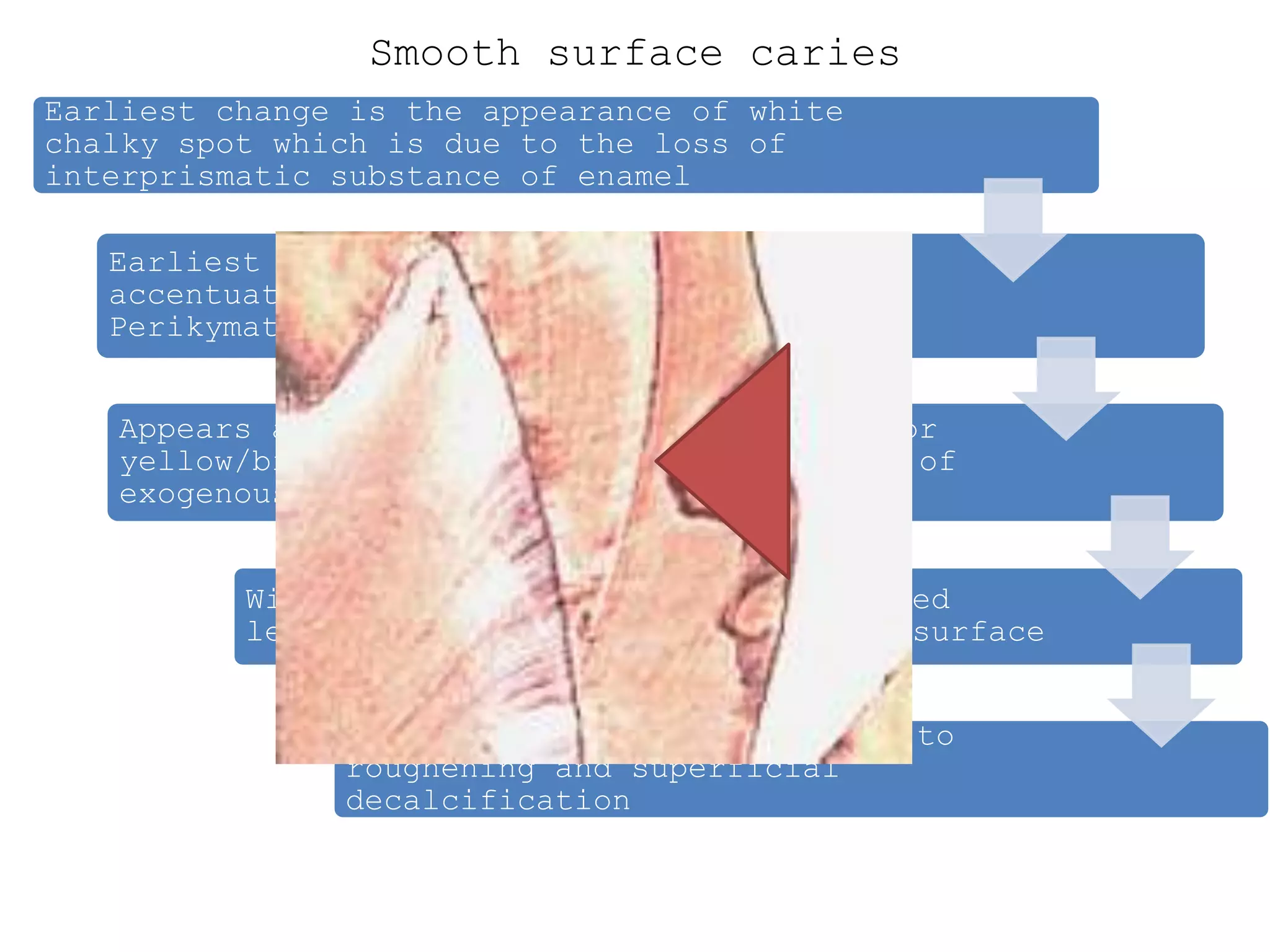 Pathogenesis of dental caries | PPSX