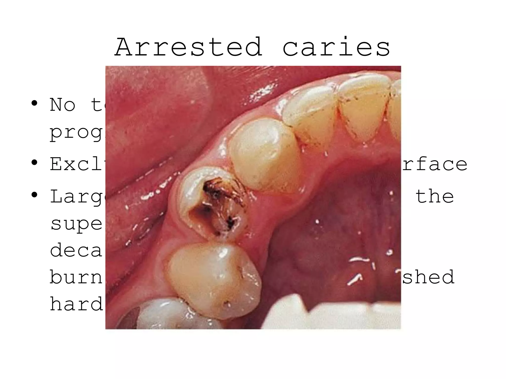 Pathogenesis of dental caries | PPSX