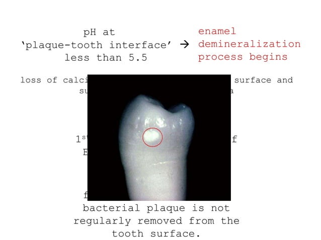 Pathogenesis of dental caries | PPSX | Dental Health | Diseases and ...