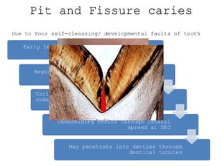 Pathogenesis of dental caries | PPSX