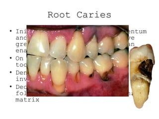 Pathogenesis of dental caries | PPSX