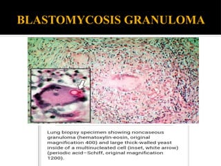 THE PATHOGENESIS OF FUNGAL INFECTIONS.pptx