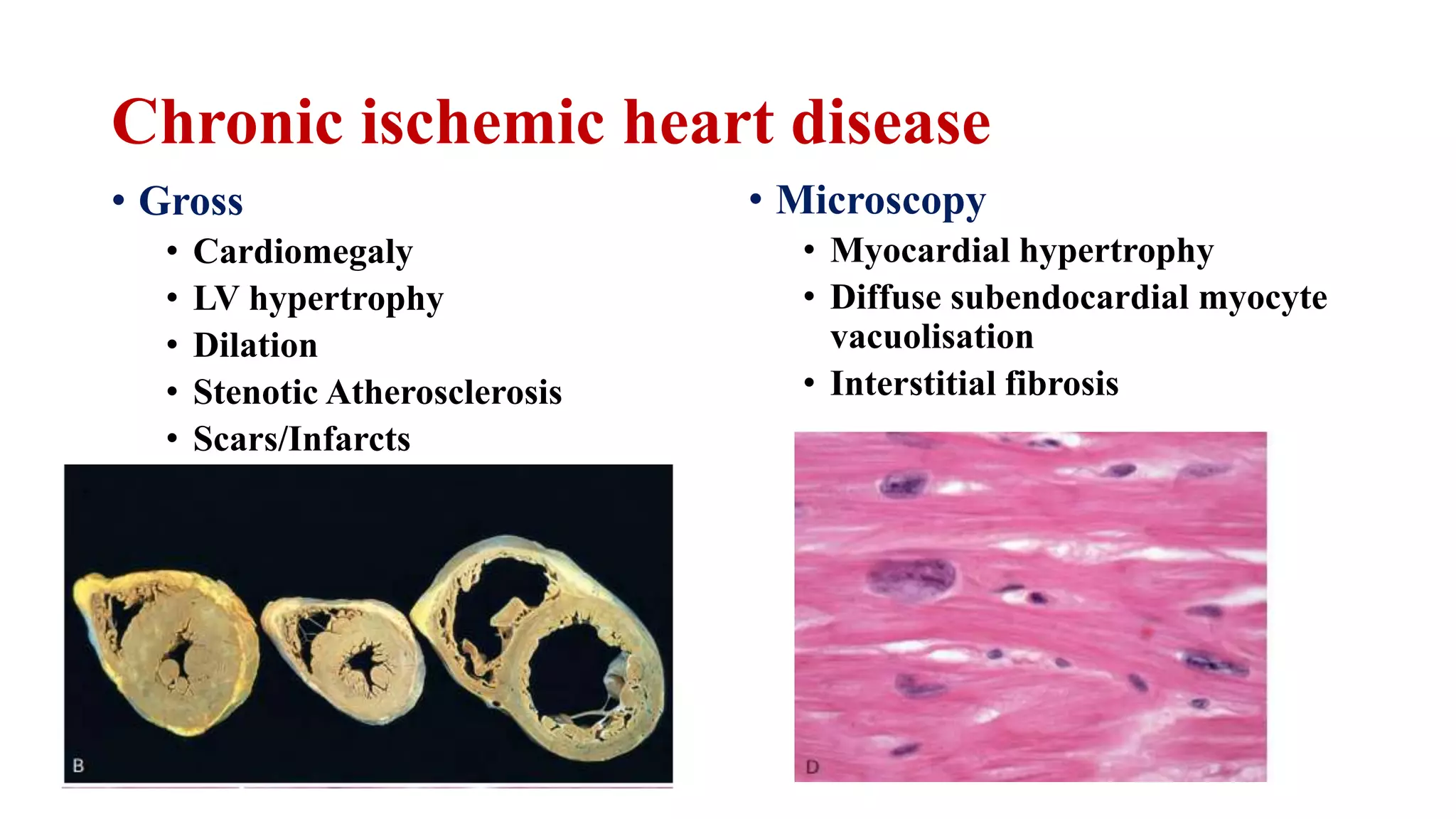 Ischemic heart disease | PPTX