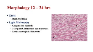 Ischemic heart disease | PPTX