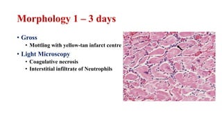 Ischemic heart disease | PPTX
