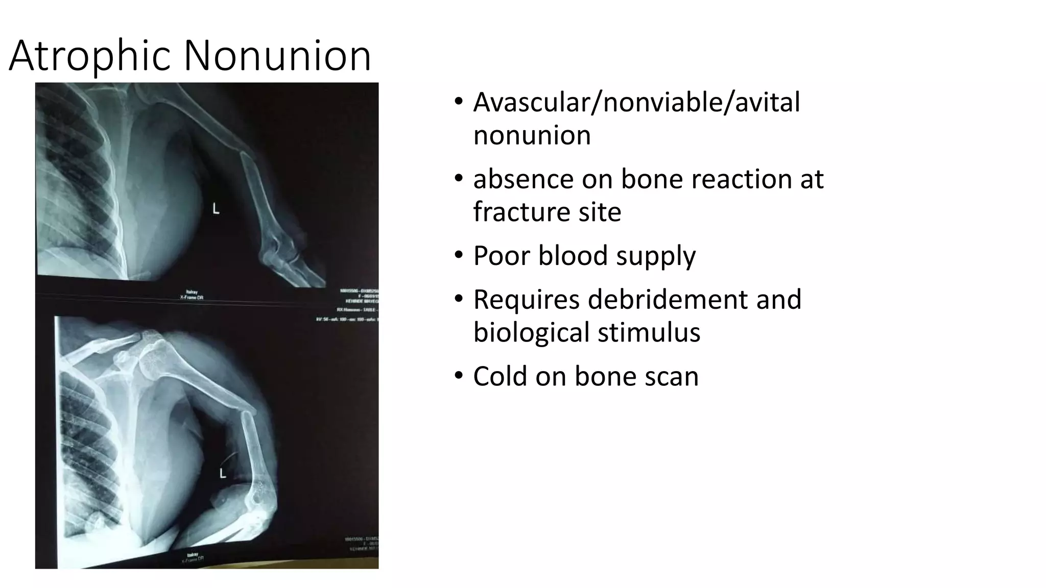PATHOGENESIS OF NON-UNION.pptx