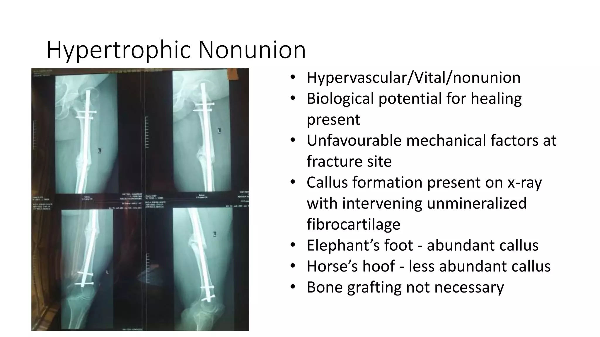 PATHOGENESIS OF NON-UNION.pptx