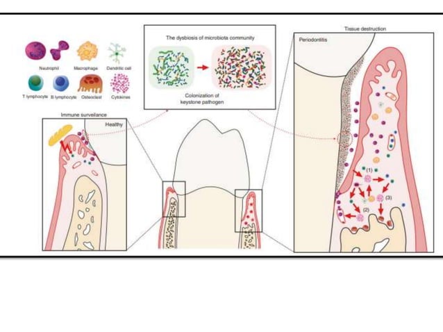 pathogenesis of periodontal.pptx