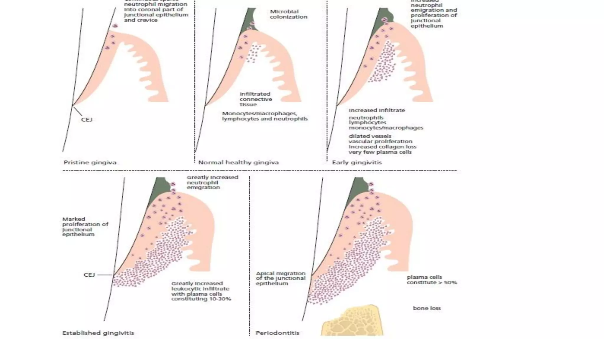 Pathogenesis of periodontal diseases | PDF