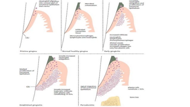 Pathogenesis of periodontal diseases