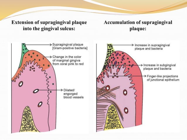 Pathogenesis of plaque associated periodontal disease | PPTX | Dental ...