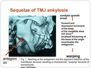 Pathogenesis of post traumatic ankylosis of the temporomandibular joint ...