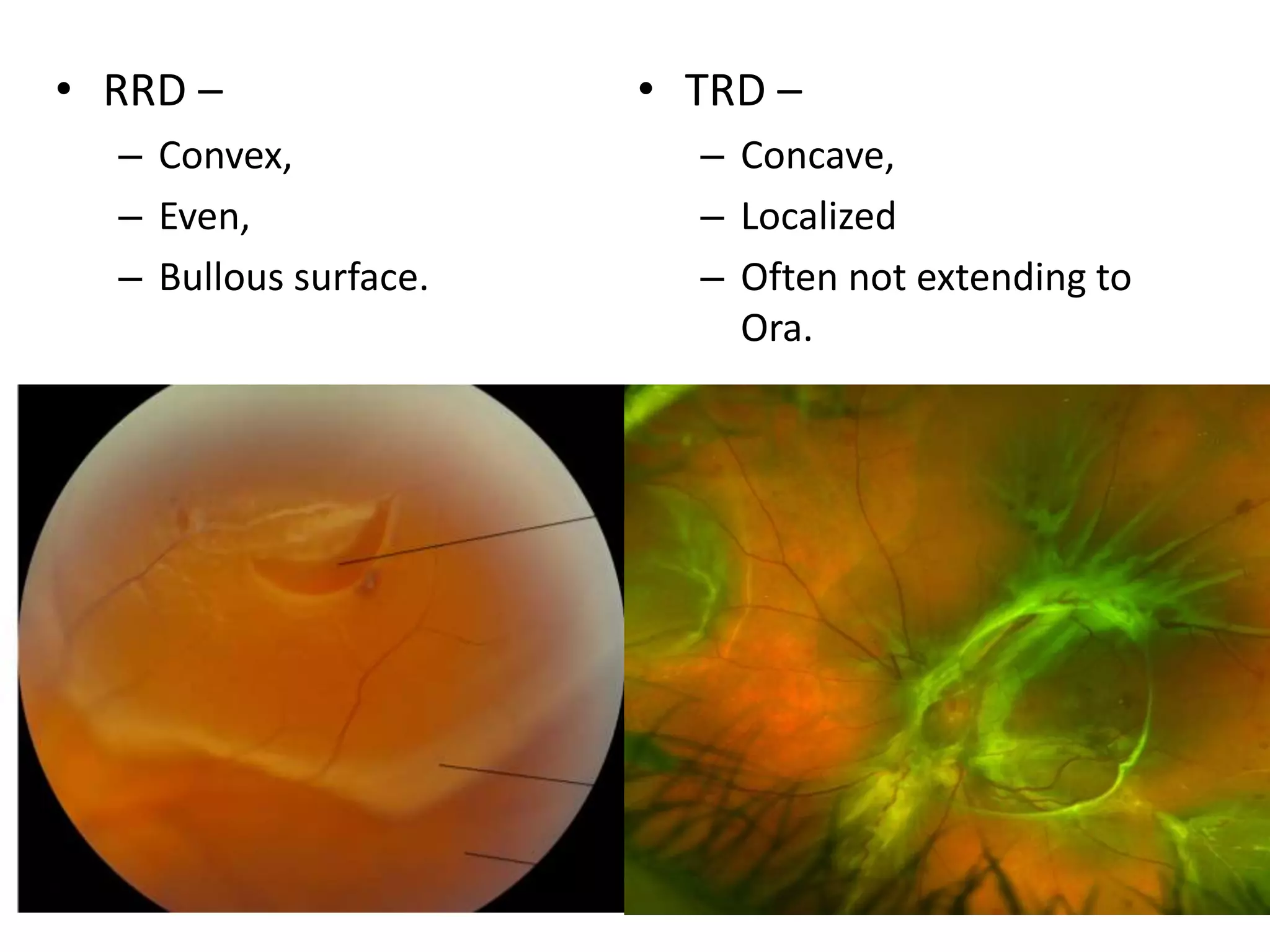 Pathogenetic mechanism of Retinal Detachment | PPTX