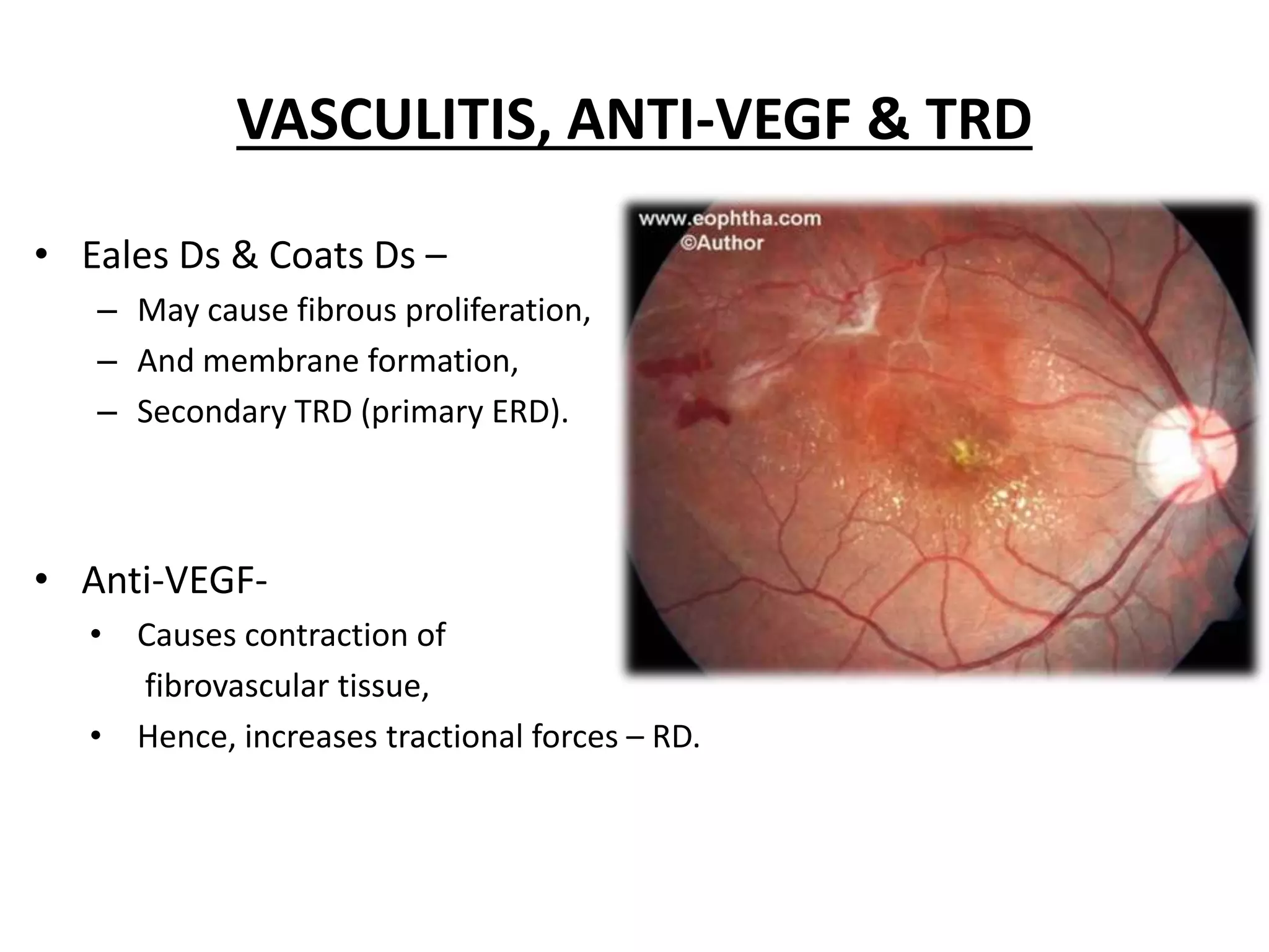 Pathogenetic mechanism of Retinal Detachment | PPTX