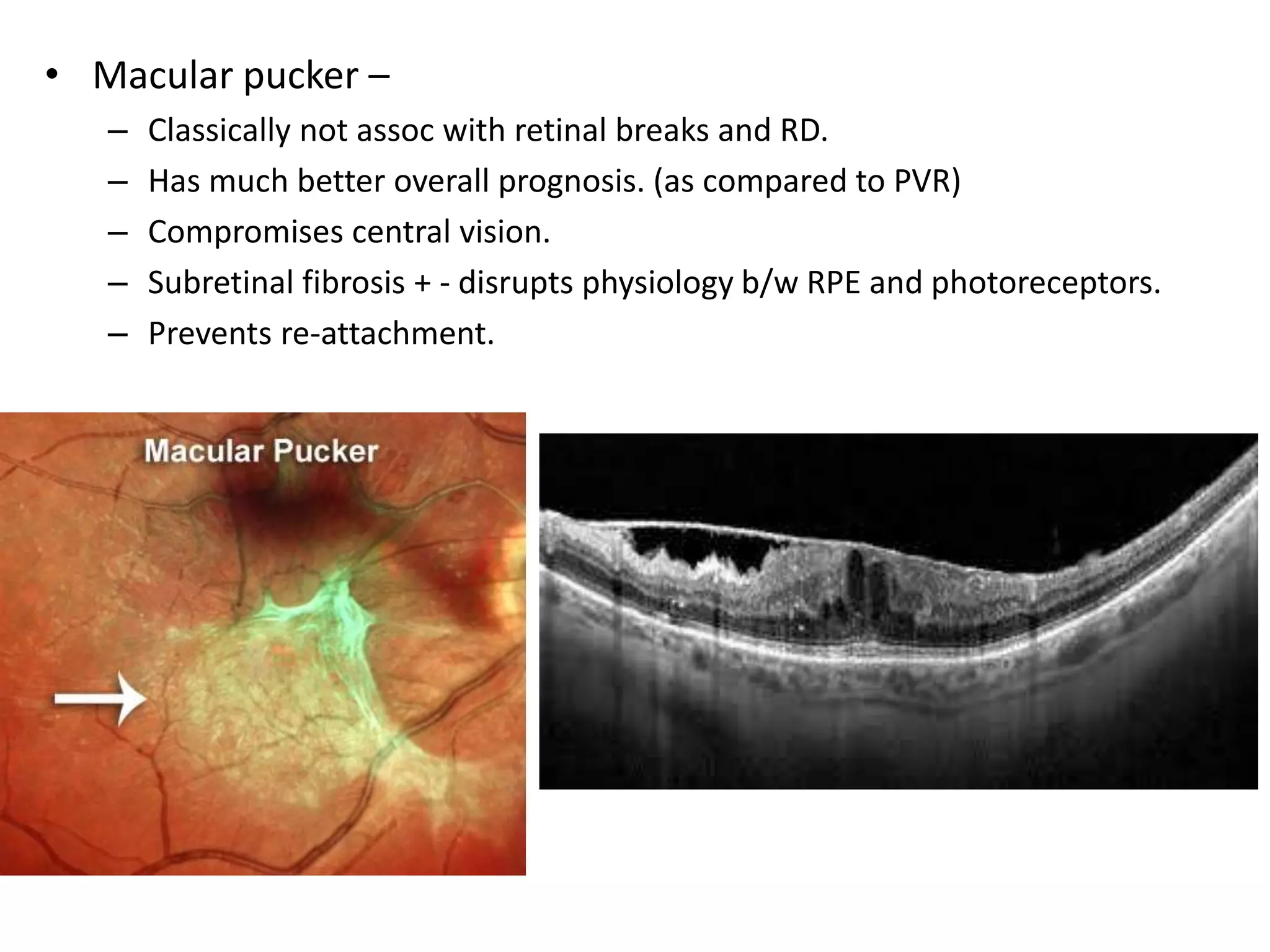Pathogenetic mechanism of Retinal Detachment | PPTX