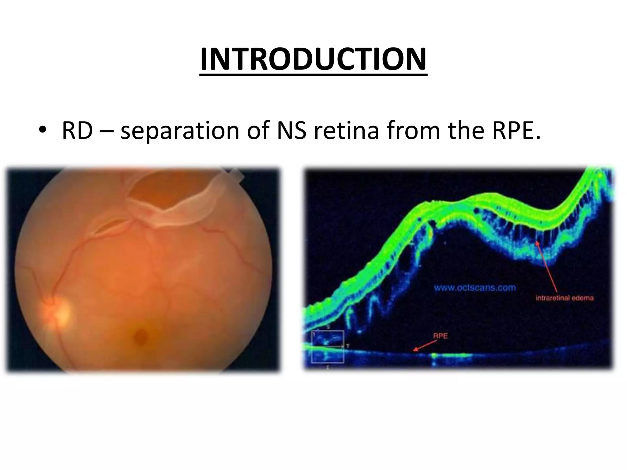 Pathogenetic mechanism of Retinal Detachment | PPTX