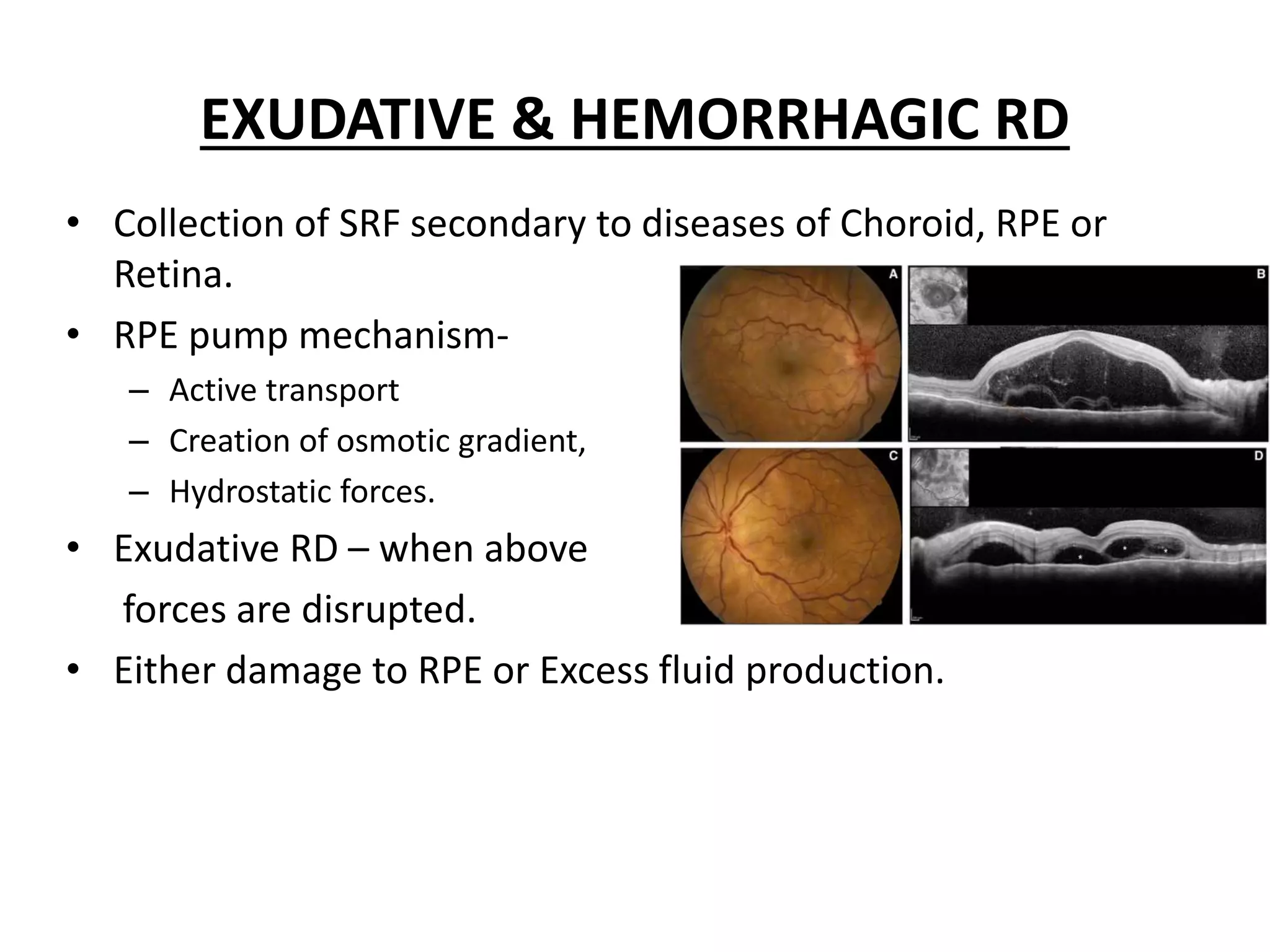 Pathogenetic mechanism of Retinal Detachment | PPTX