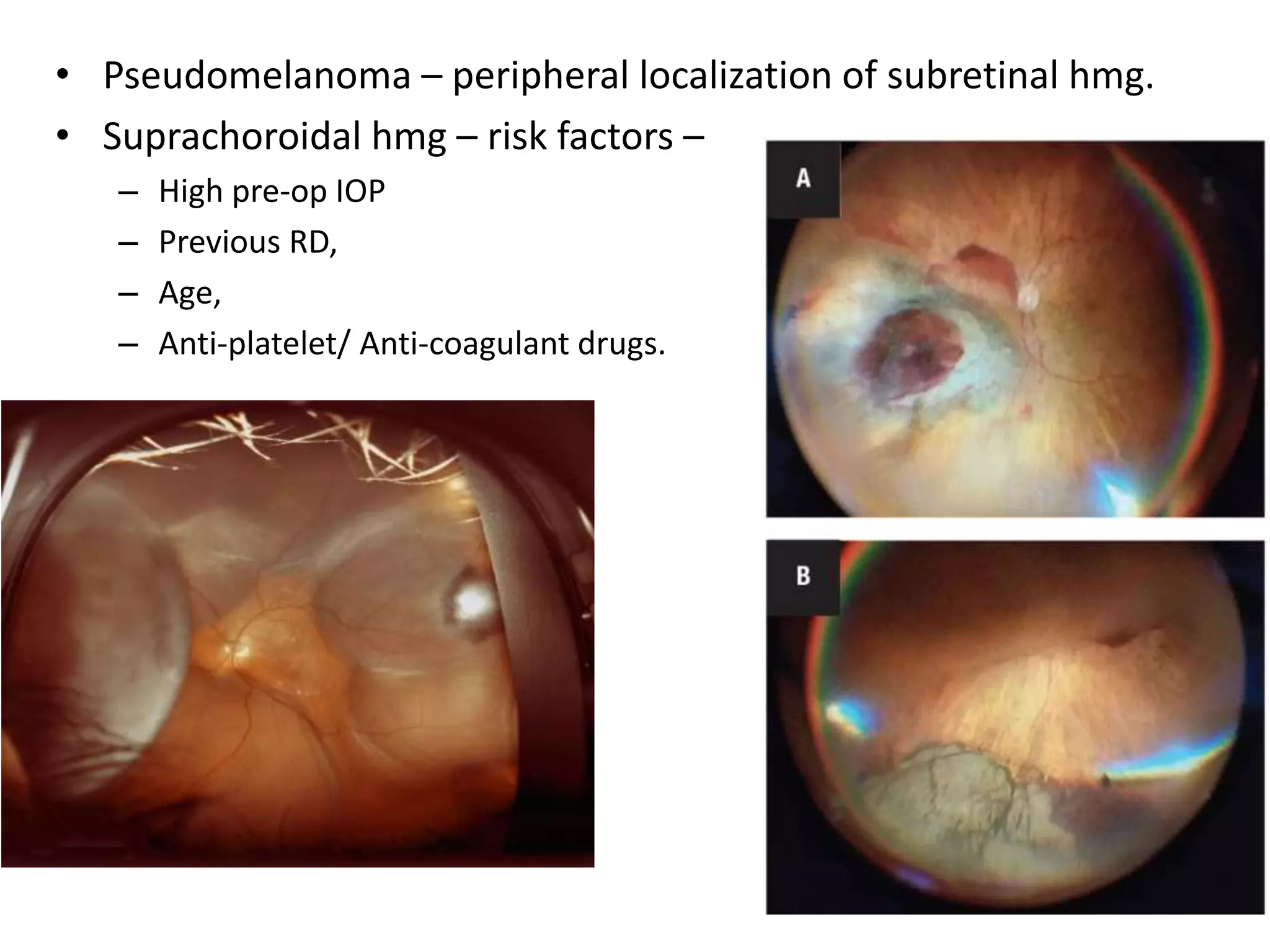 Pathogenetic mechanism of Retinal Detachment | PPTX