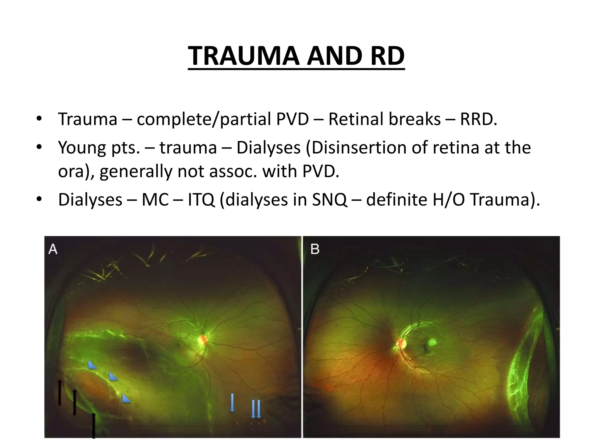 Pathogenetic mechanism of Retinal Detachment | PPTX