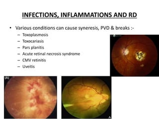 Pathogenetic mechanism of Retinal Detachment | PPTX