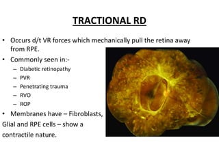 Pathogenetic mechanism of Retinal Detachment | PPTX