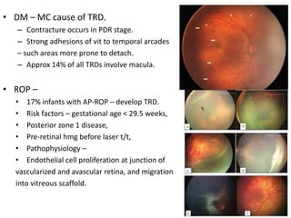 Pathogenetic mechanism of Retinal Detachment | PPTX