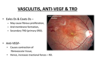 Pathogenetic mechanism of Retinal Detachment | PPTX