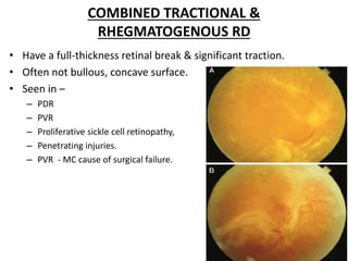 Pathogenetic mechanism of Retinal Detachment | PPTX