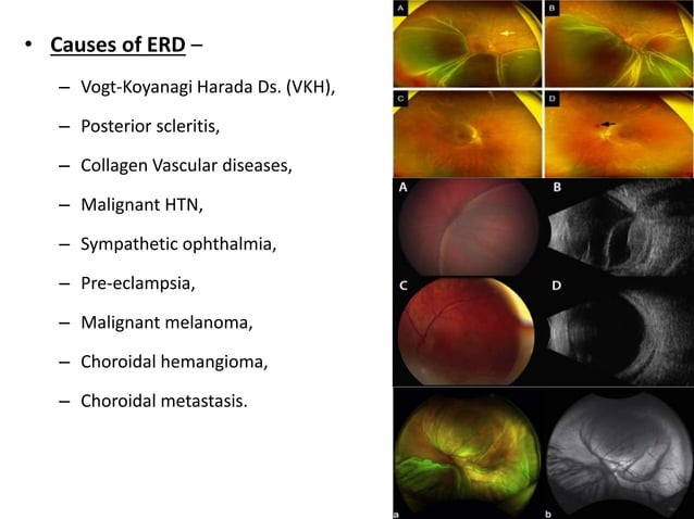 Pathogenetic mechanism of Retinal Detachment | PPTX