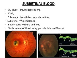 Pathogenetic mechanism of Retinal Detachment | PPTX